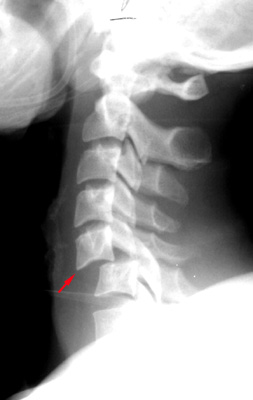 Imaging Evaluation of Cervical Spine